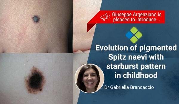 Evolution Of Pigmented Spitz Naevi With Starburst Pattern In Childhood